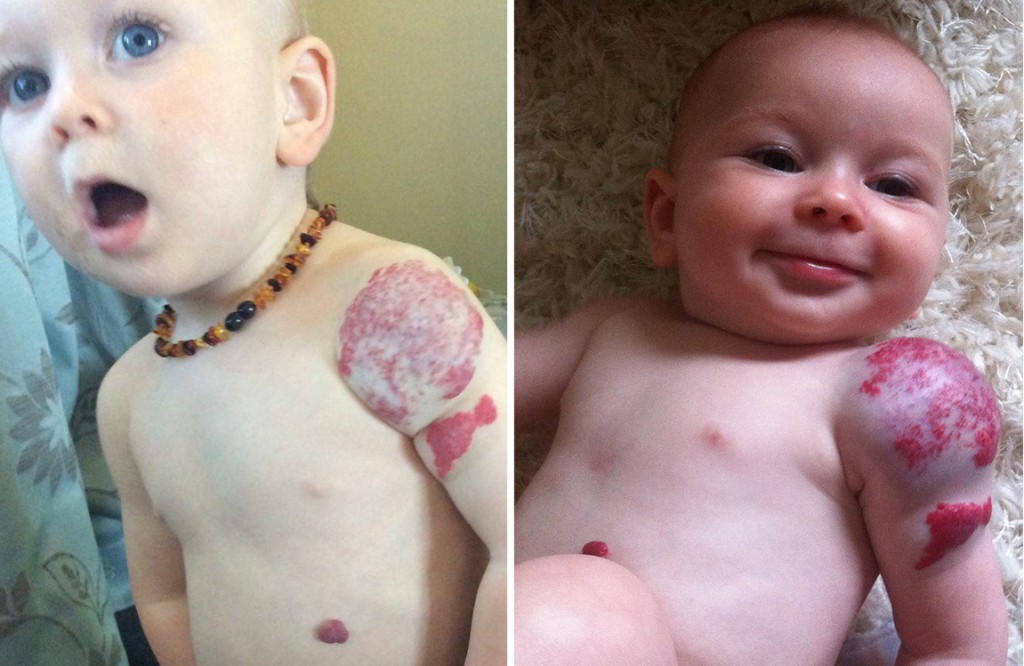 Meet the little boy with the shoulder birthmark they dubbed "Popeye ...