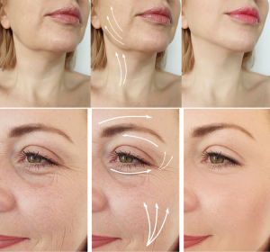 Everything You Need To Know About Thread Lift Treatment - Mouths of Mums