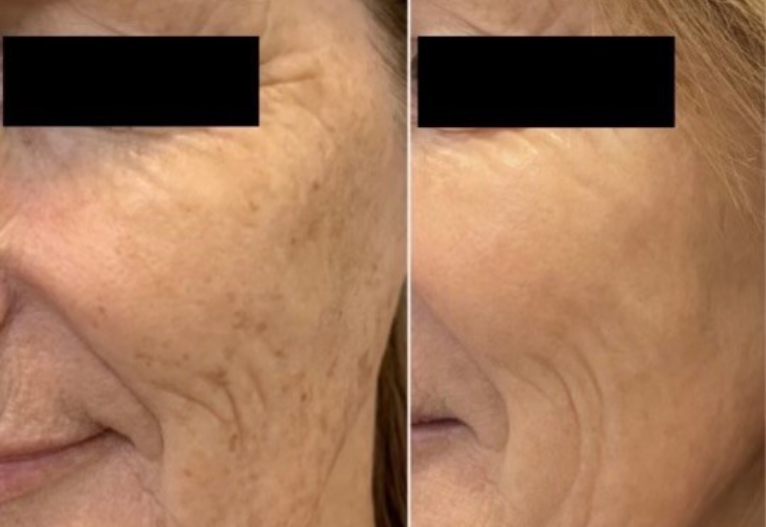 Unlock the Power Of Agelessly Beautiful Skin with BBL Hero - Mouths of Mums